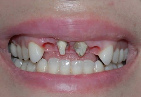 Multiple Teeth Implants San Diego | San Diego Multiple Teeth Implants